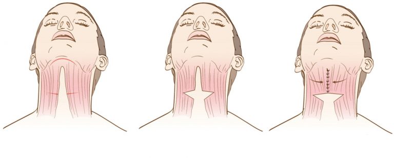 Neck Lift for Orlando, Winter Park & Tampa, FL – Primera Plastic Surgery