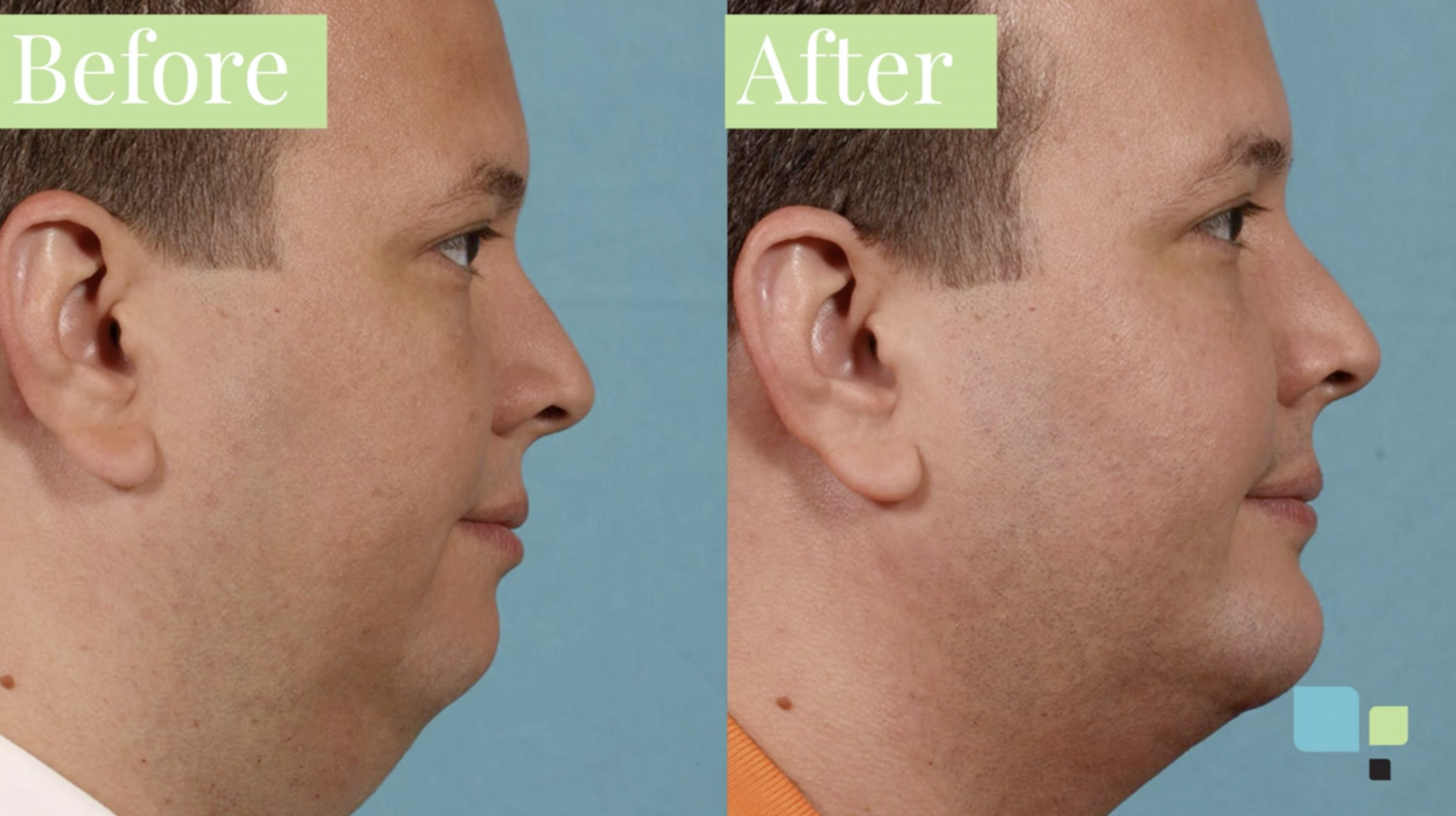 Buccal Fat Removal