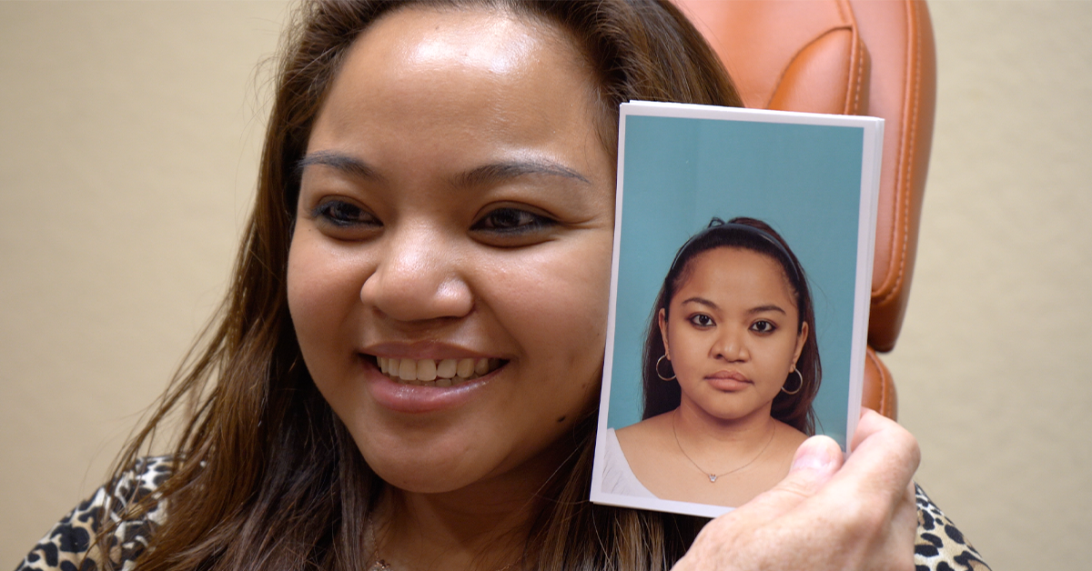 Cleft Lip Revision Surgery Recovery - Infoupdate.org