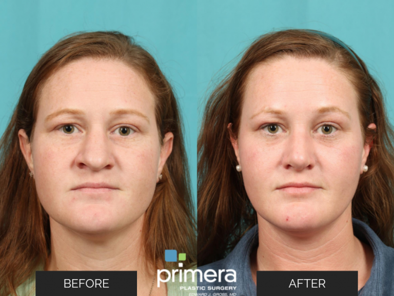 Can Rhinoplasty Be Combined With Other Facial Procedures? 6 Real ...