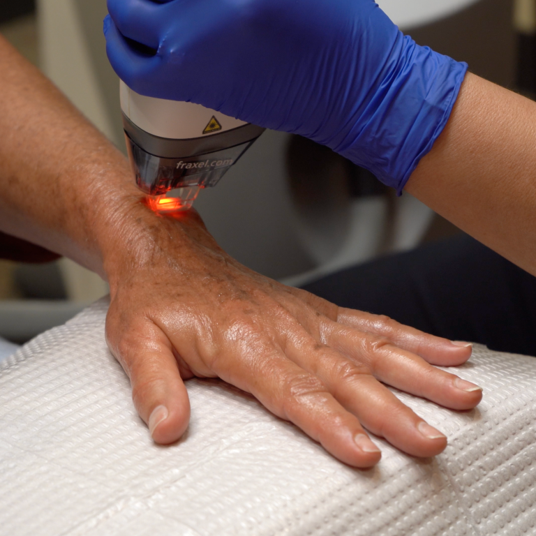 What Is Fraxel? – Primera Plastic Surgery